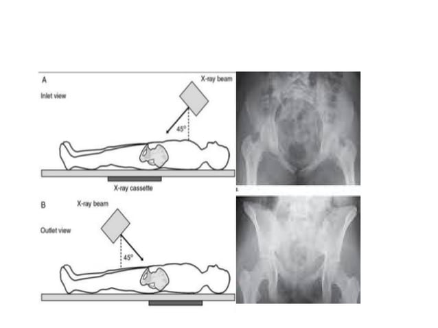 PELVIC FRACTURES in orthopaedics FINAL.pptx