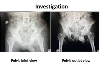 Pelvic fx | PPTX