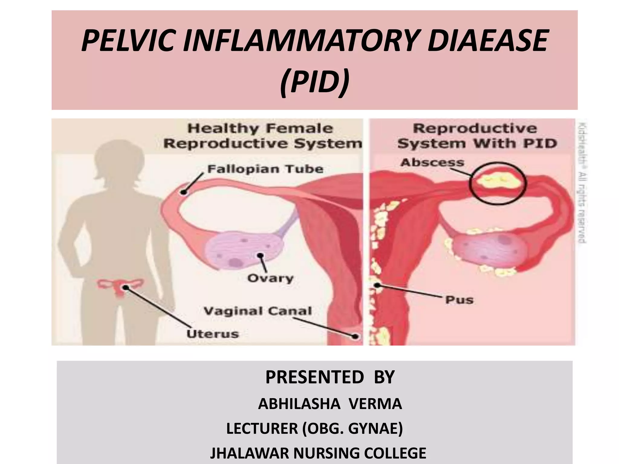 Pelvic inflammatory diaease | PPTX
