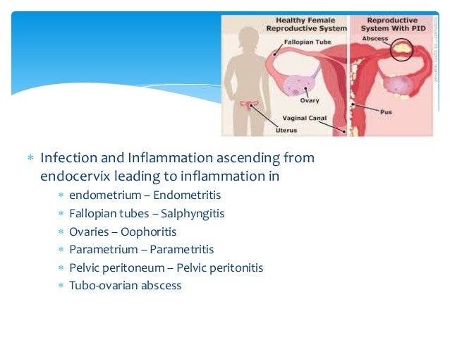 Pelvic inflammatory disease