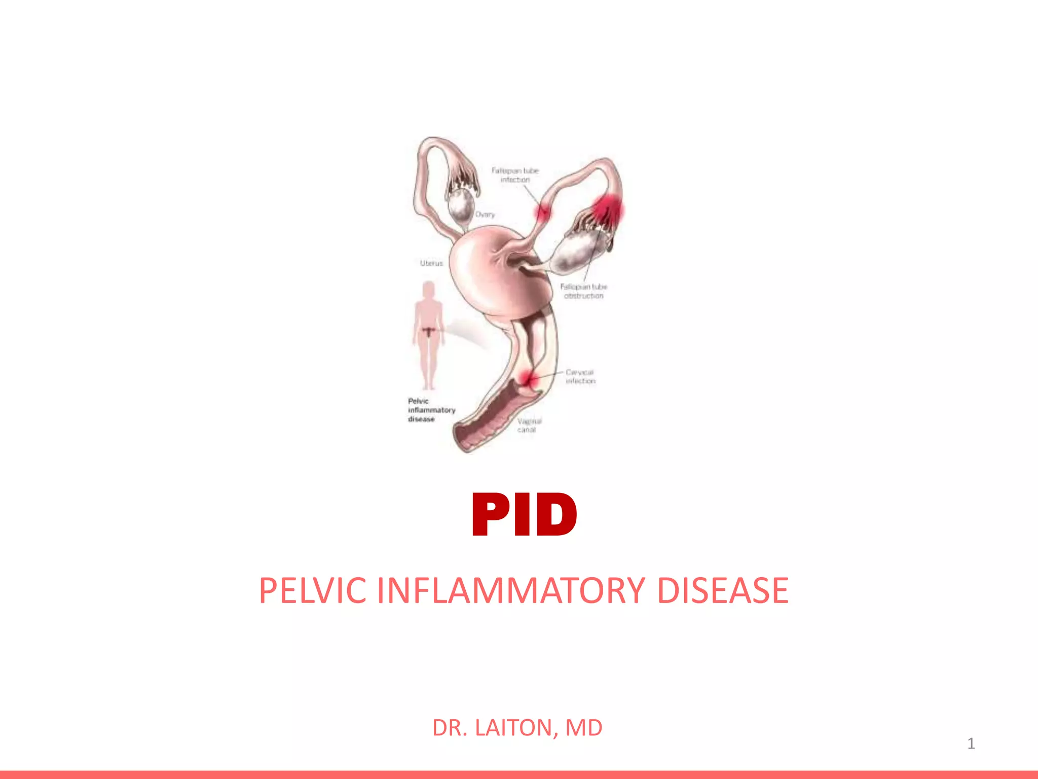 Pelvic Inflammatory Disease | PPTX