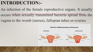 Pelvic inflammatory disease.pdf