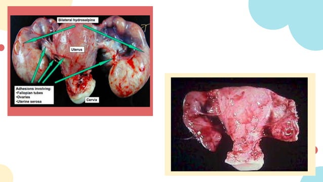 Pelvic Inflammatory Disease- acute and subclinical infection of the ...