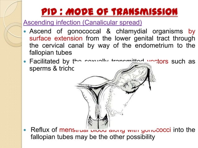 Pelvic inflammatory disease | PPTX