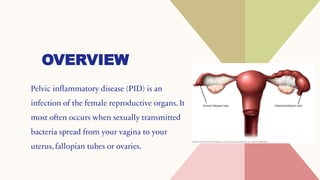 Pelvic inflammatory disease PID presentation | PPT