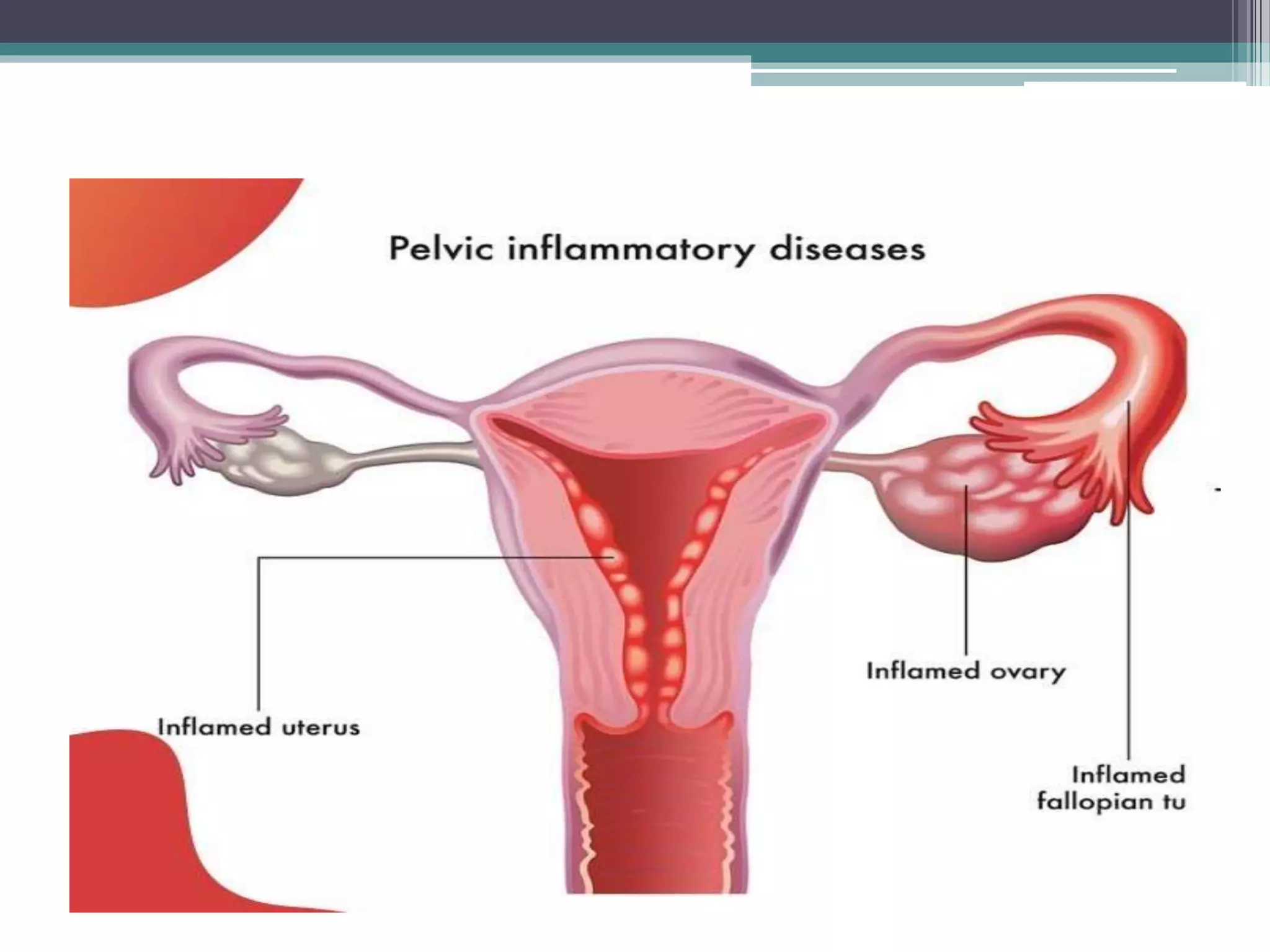 Pelvic inflammatory diseases in females | PPT