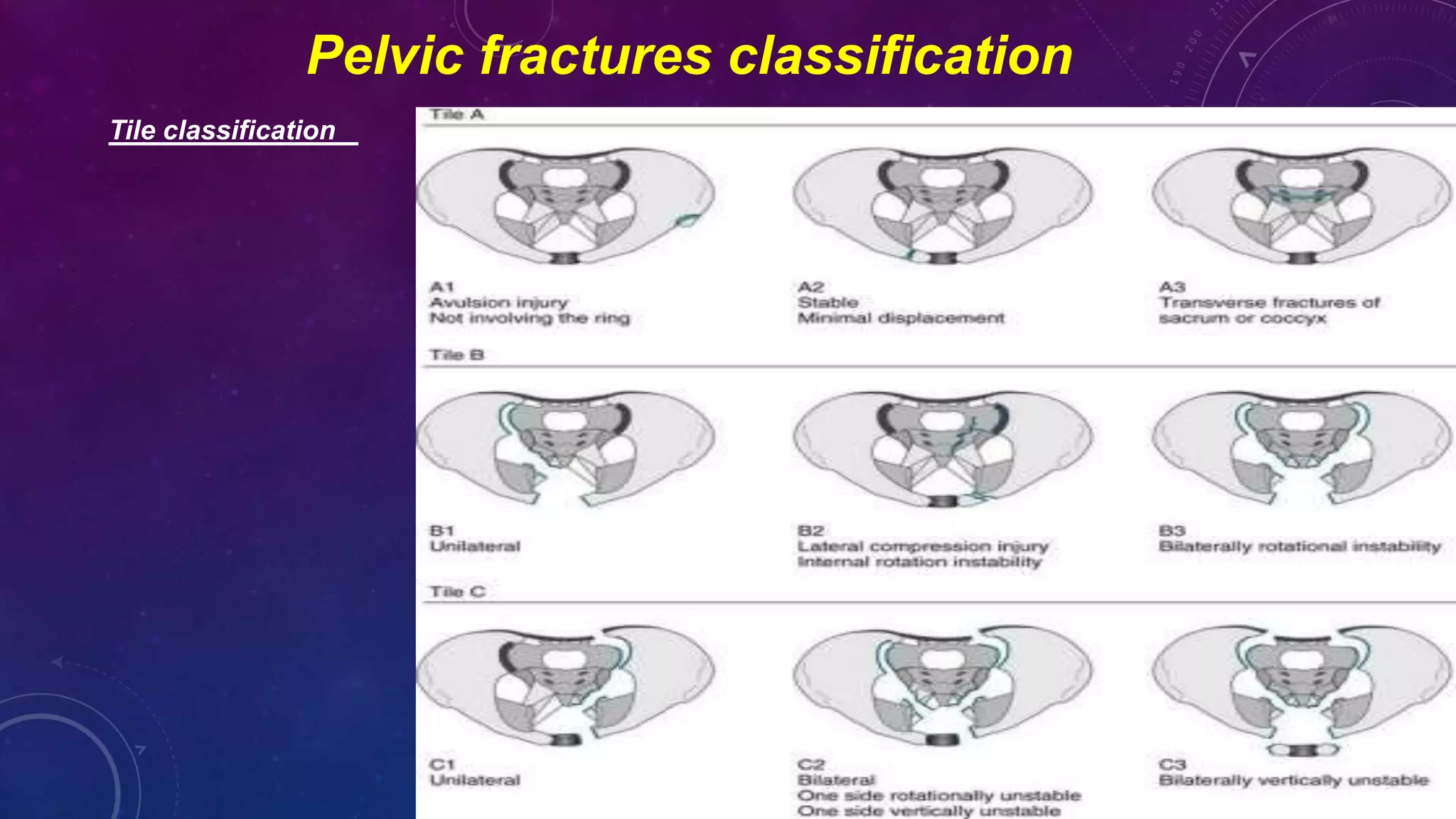 Pelvic injuries and associated injuries | PPTX