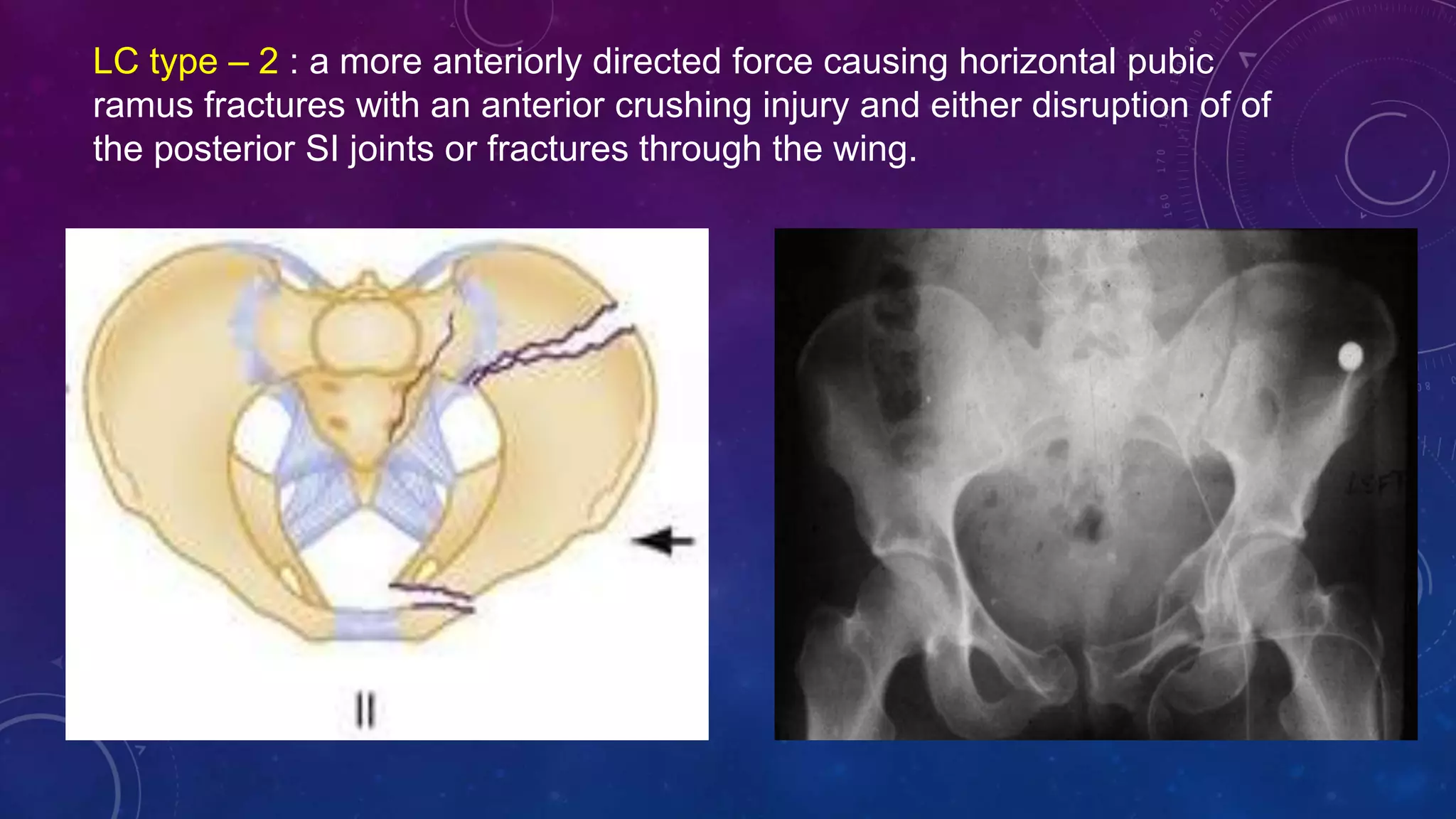 Pelvic injuries and associated injuries | PPTX