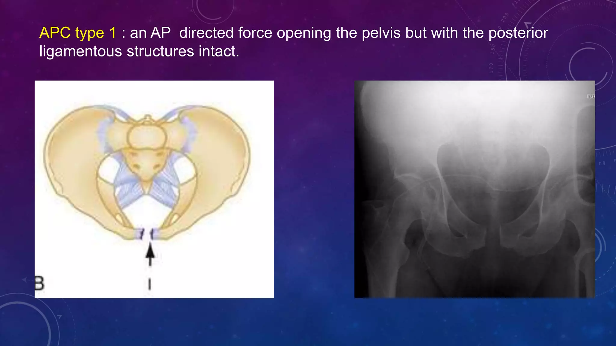 Pelvic injuries and associated injuries | PPTX