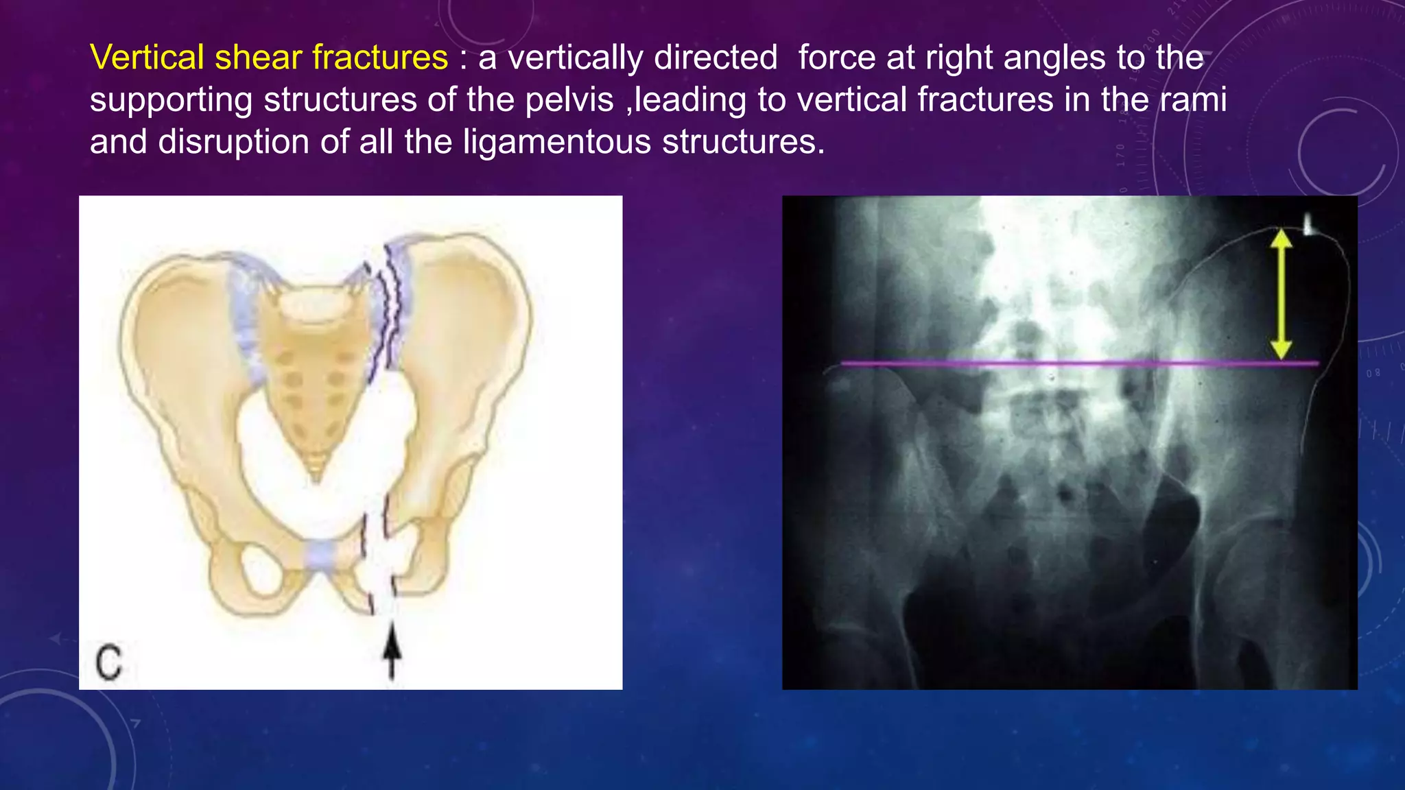 Pelvic injuries and associated injuries | PPTX