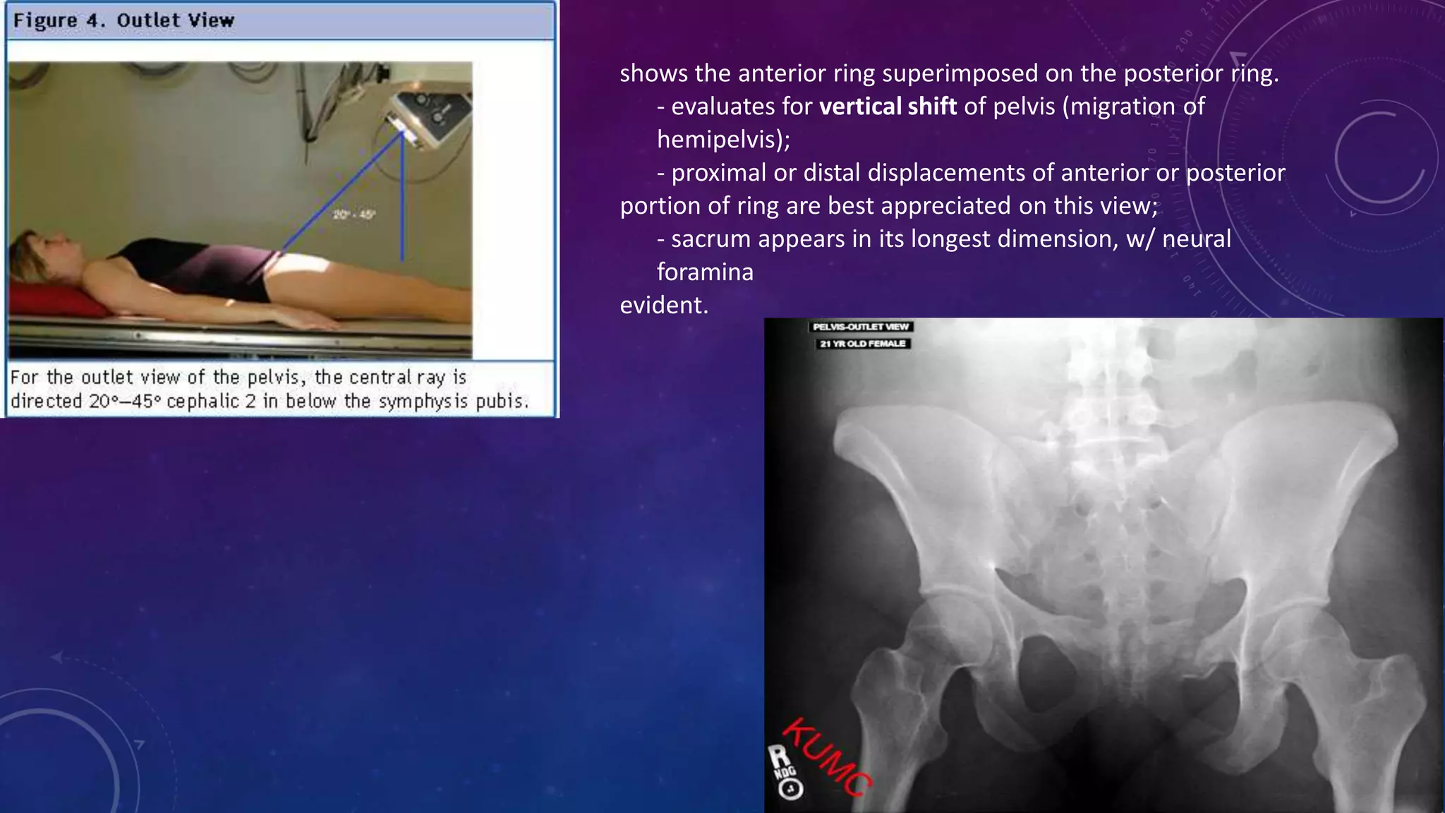 Pelvic injuries and associated injuries | PPTX