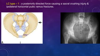 Pelvic injuries and associated injuries | PPTX
