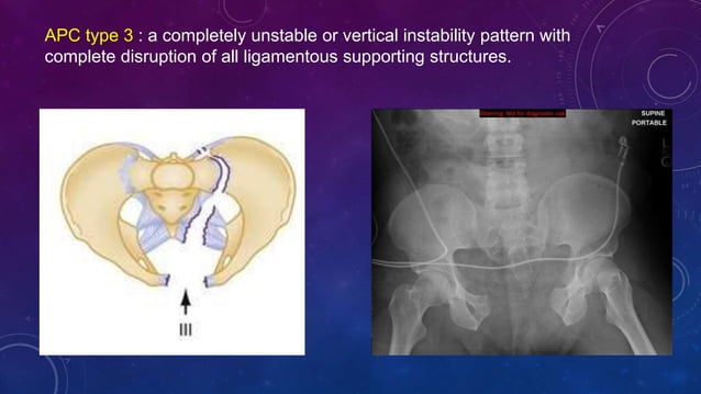 Pelvic injuries and associated injuries | PPTX