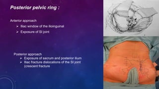 Pelvic injuries and associated injuries | PPTX