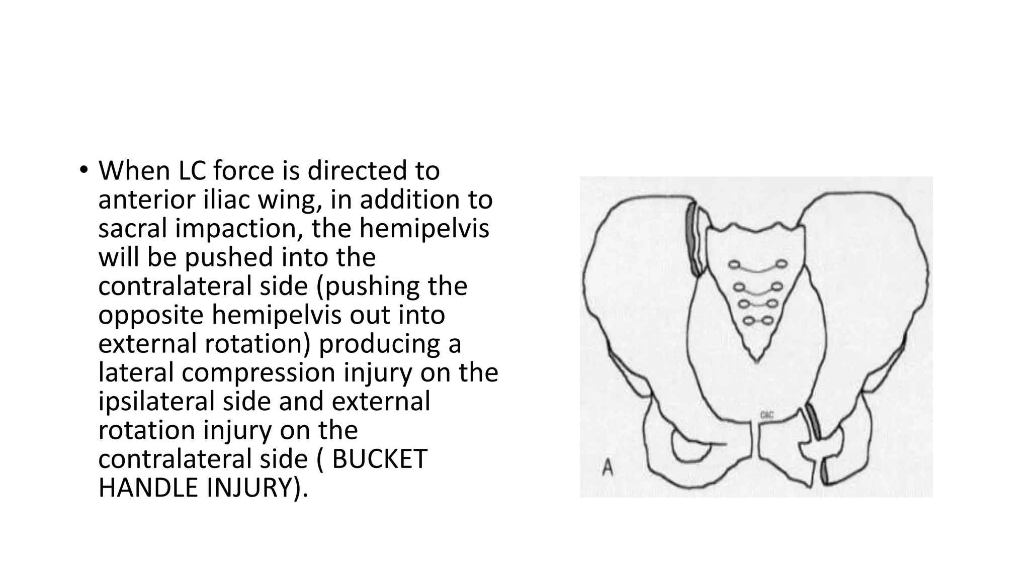 Pelvic injuries | PPTX