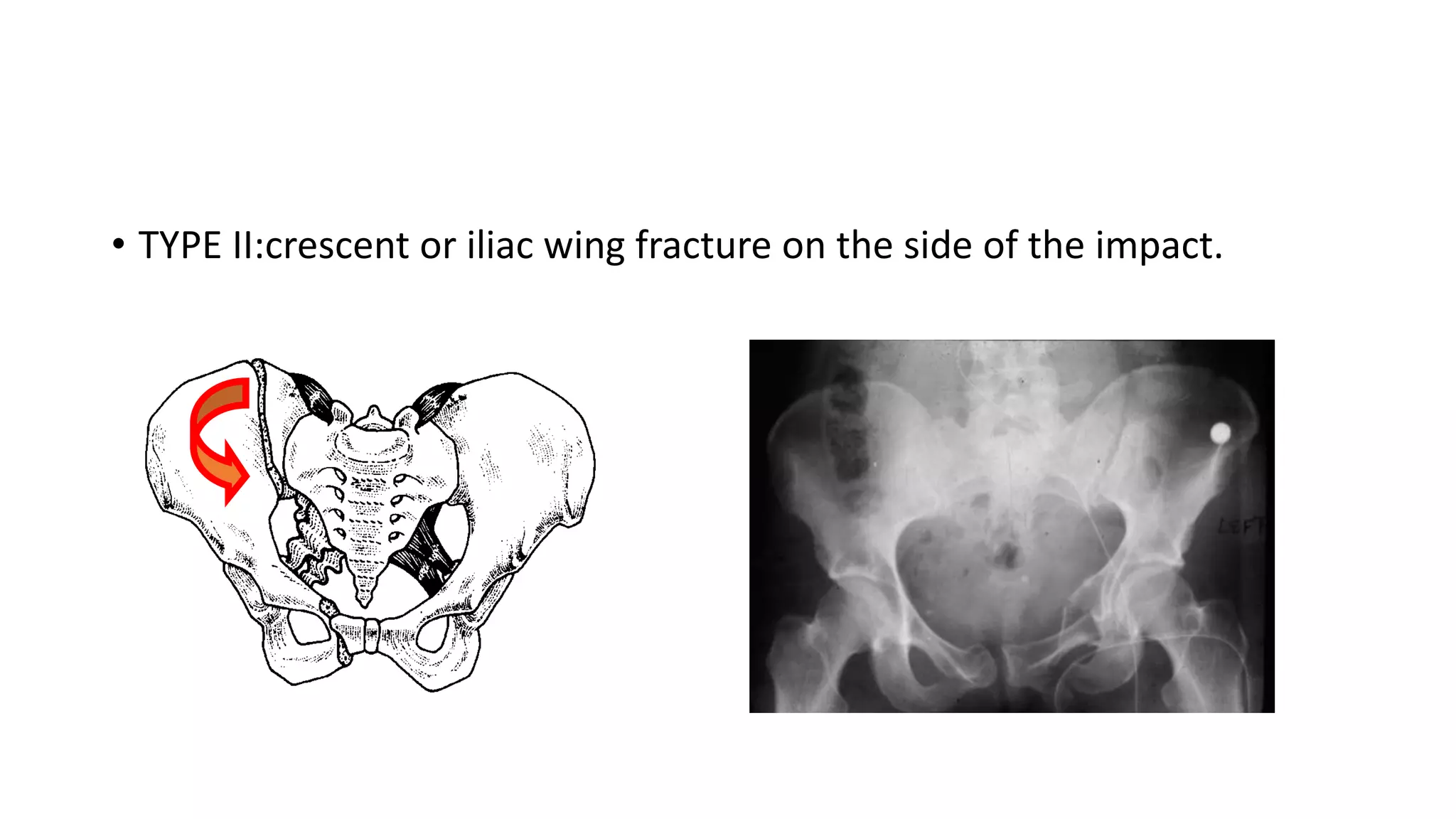 Pelvic injuries | PPTX