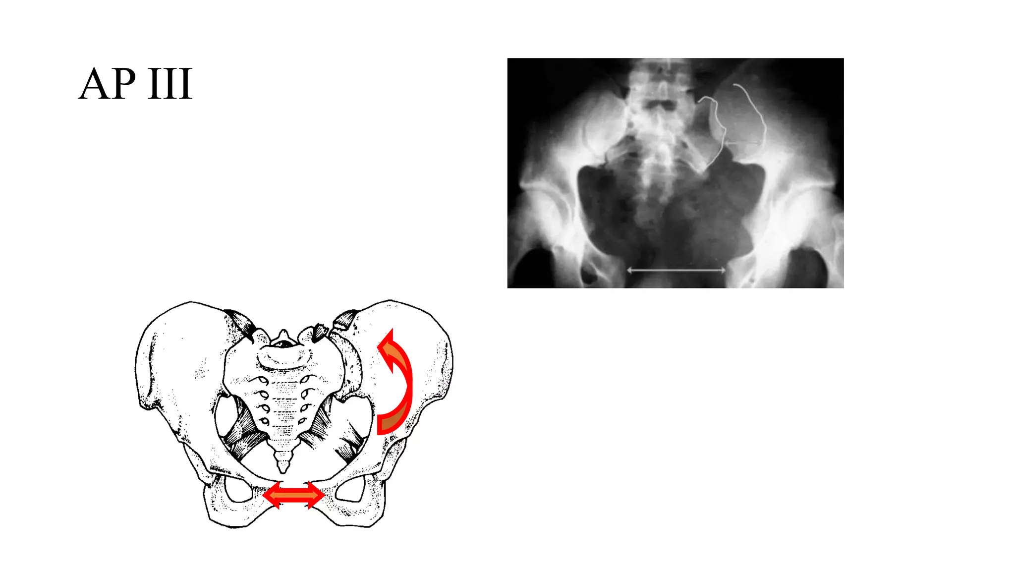 Pelvic injuries | PPTX