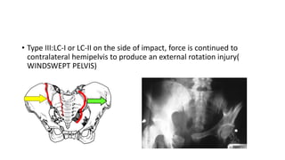 Pelvic injuries | PPTX
