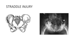 Pelvic injuries | PPT