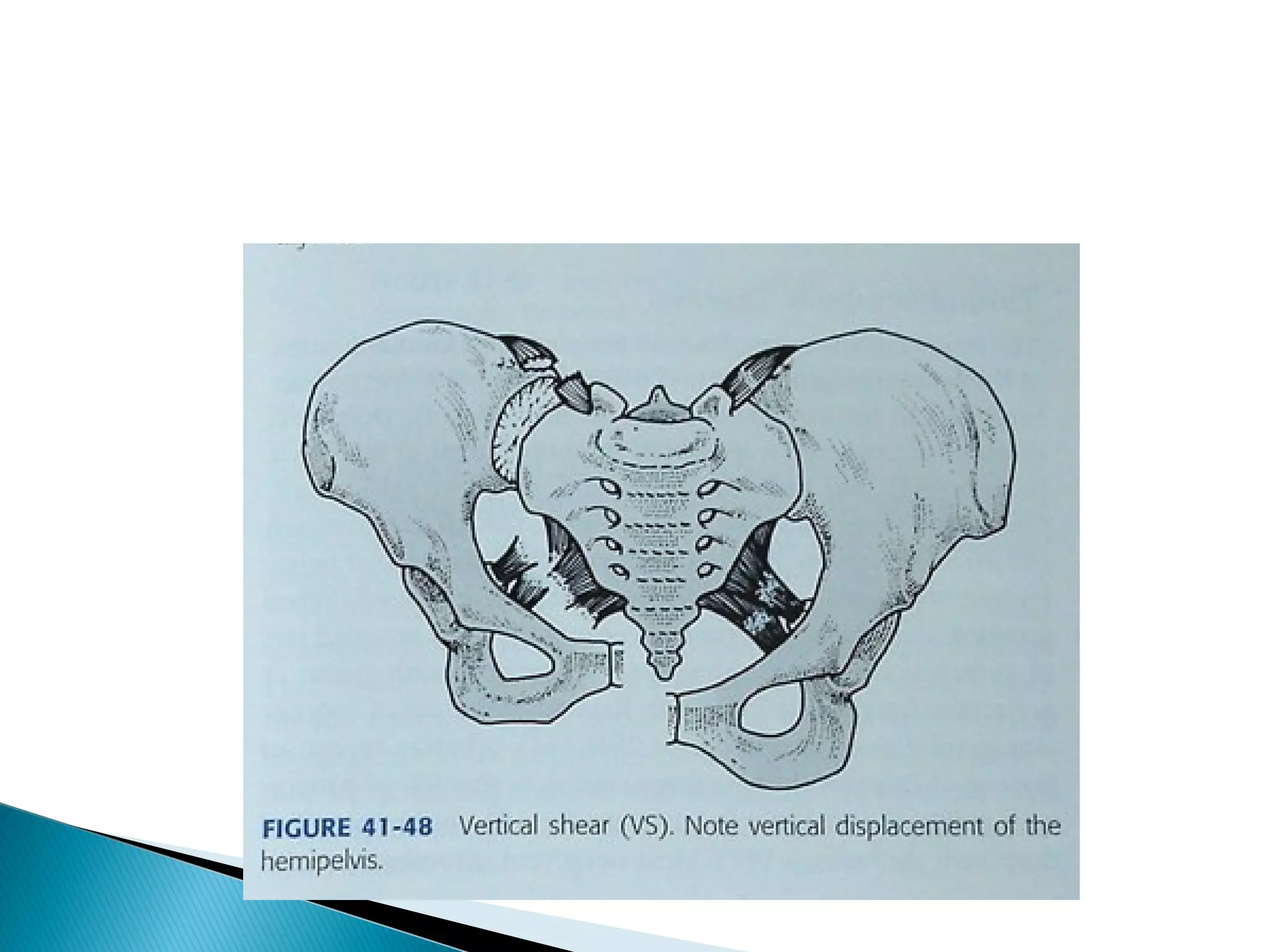 Pelvic injuries dr.satish | PPT