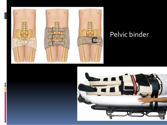 Pelvic injuries trauma 2012