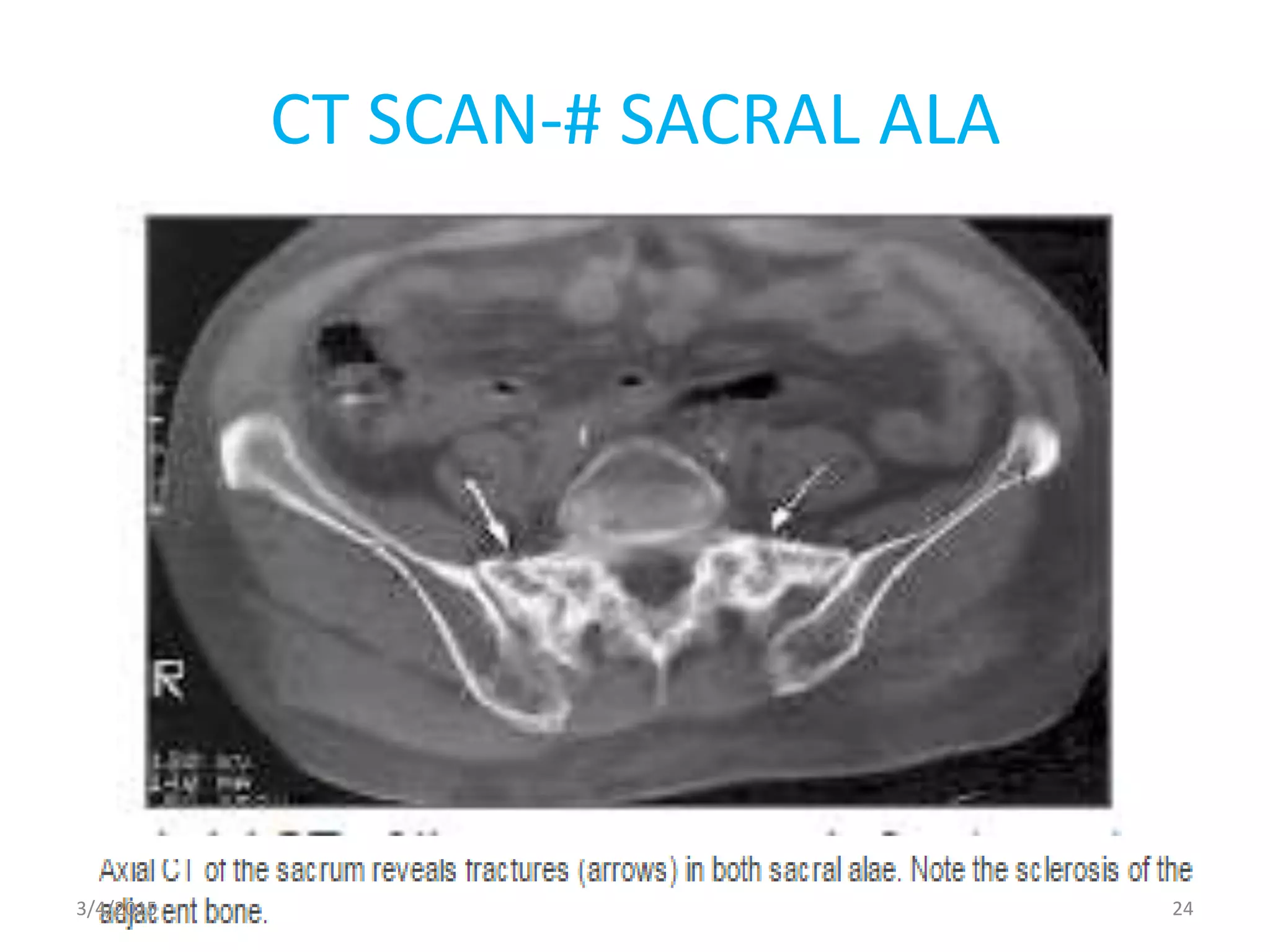 Pelvic insufficiency fracture | PPTX