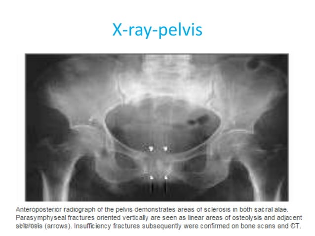 Pelvic insufficiency fracture | PPT