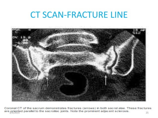 Pelvic insufficiency fracture | PPT