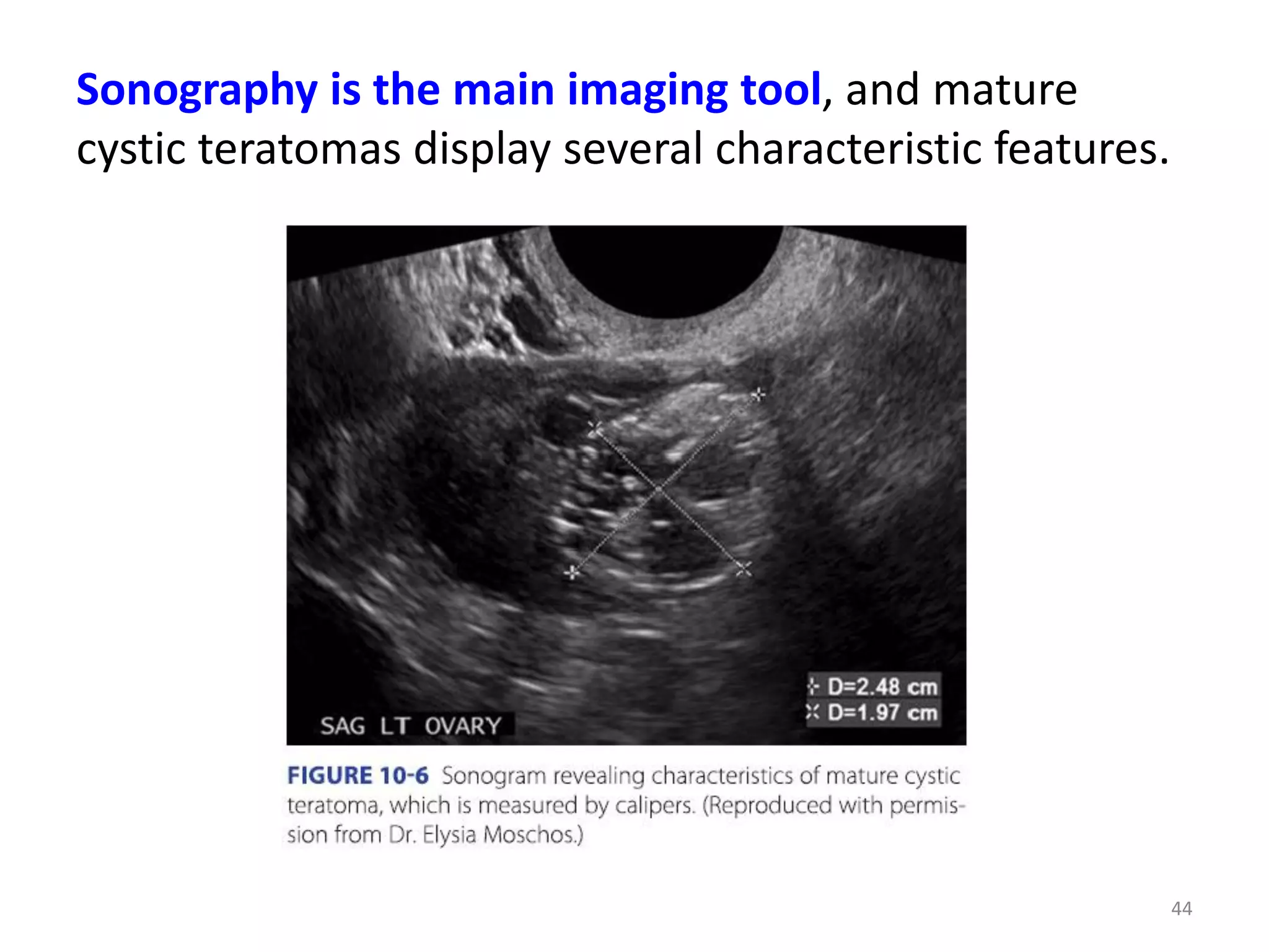 Pelvic mass Abde (2).pdf