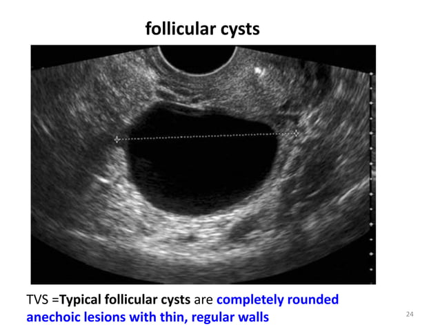 Pelvic mass Abde (2).pdf