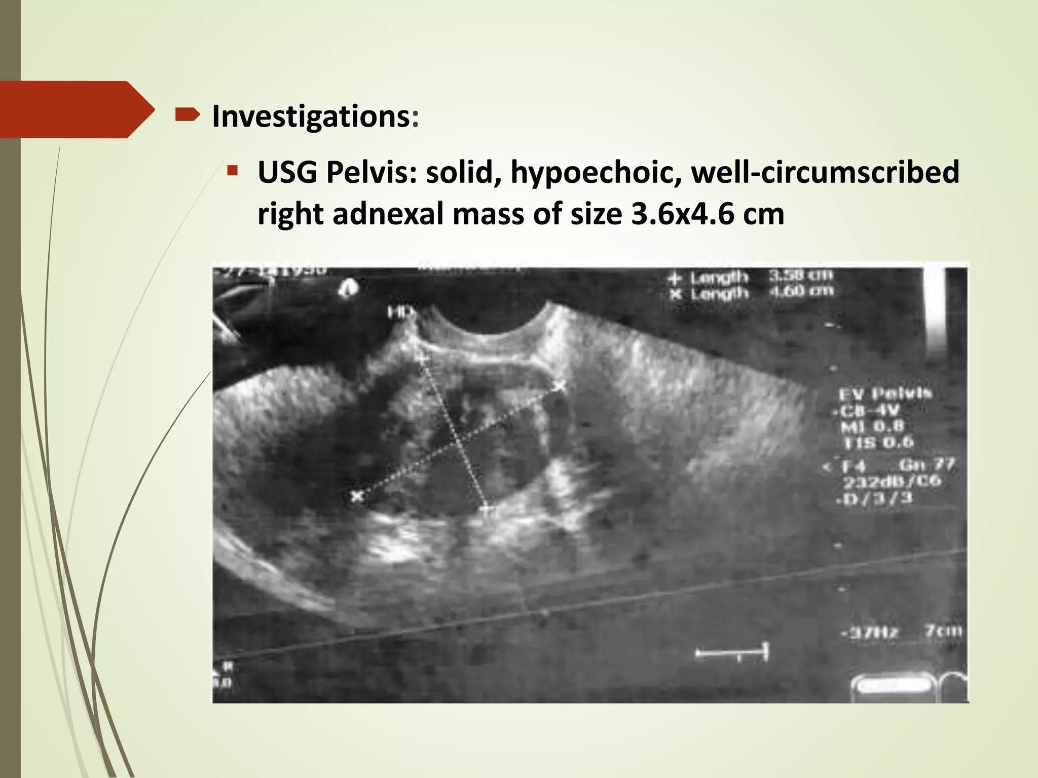 Pelvic mass panel discussion | PPTX