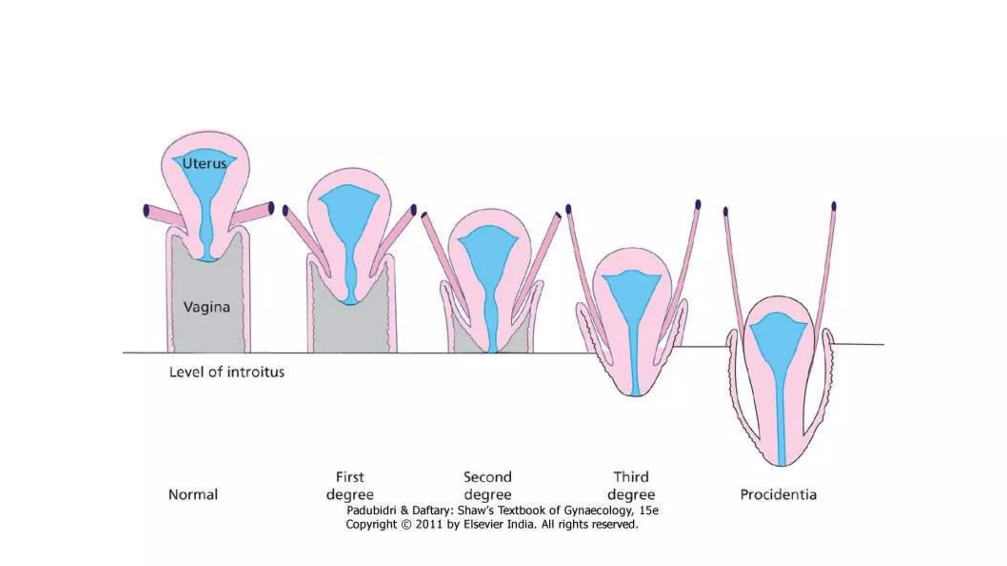 Pelvic organ prolapse gynaecology ppt | PPTX
