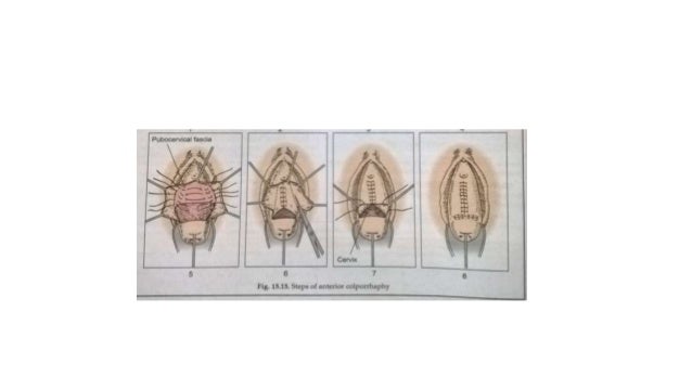 Pelvic organ prolapse gynaecology ppt