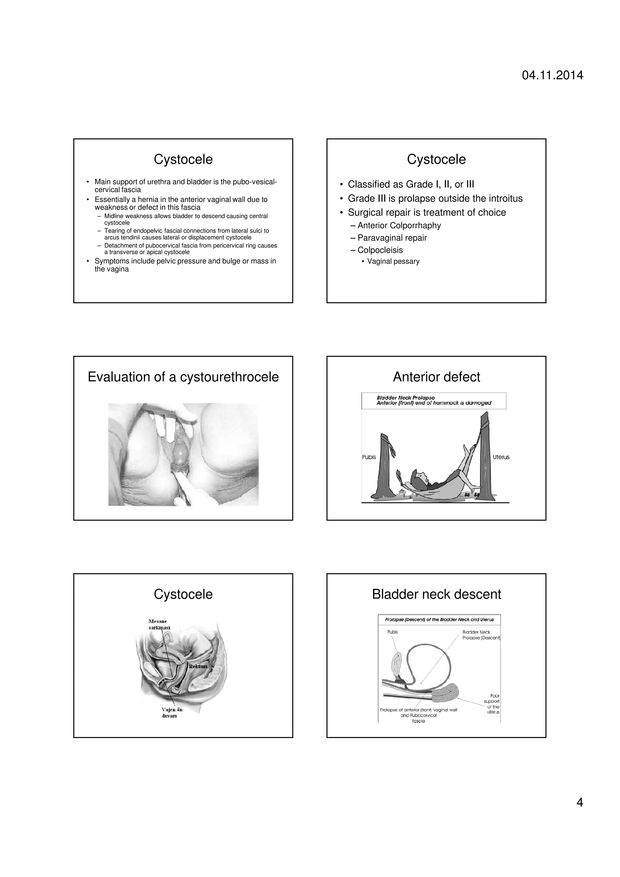 Pelvic organ prolapse - Diagnosis and treatment | PDF