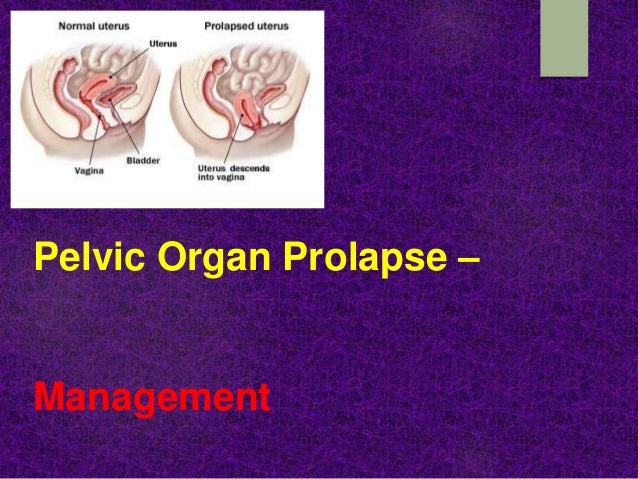 Vault Prolapse Pelvic Organ Prolapse Supports Of Uterus