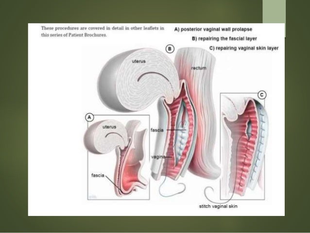 Pelvic Organ Prolapse Management