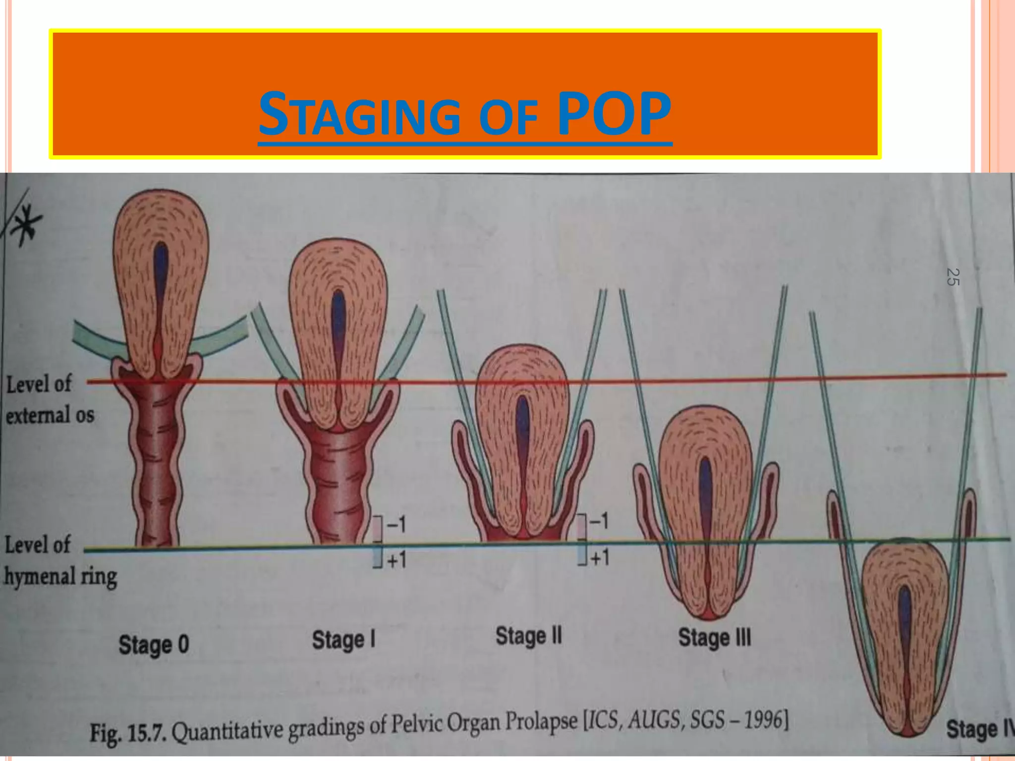 Pelvic organ prolapse | PPTX