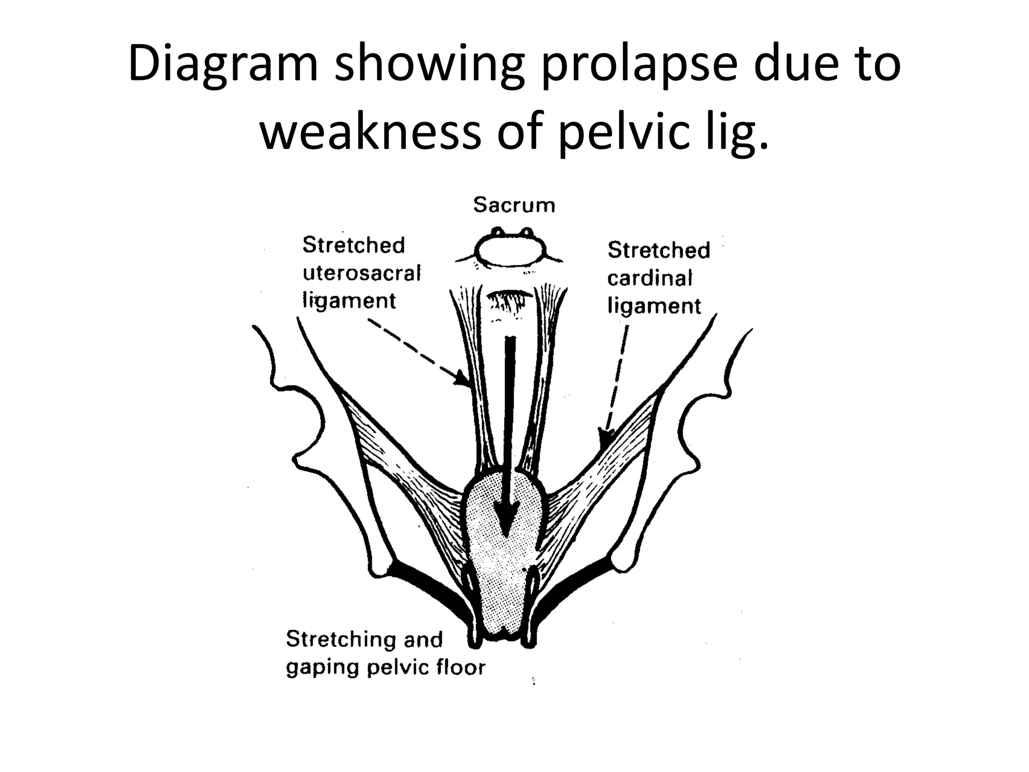 Pelvic organ prolapse | PPTX