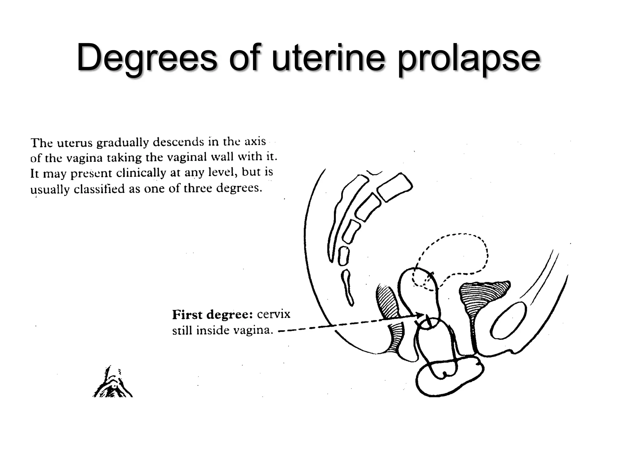 Pelvic Organ Prolapse Ppt