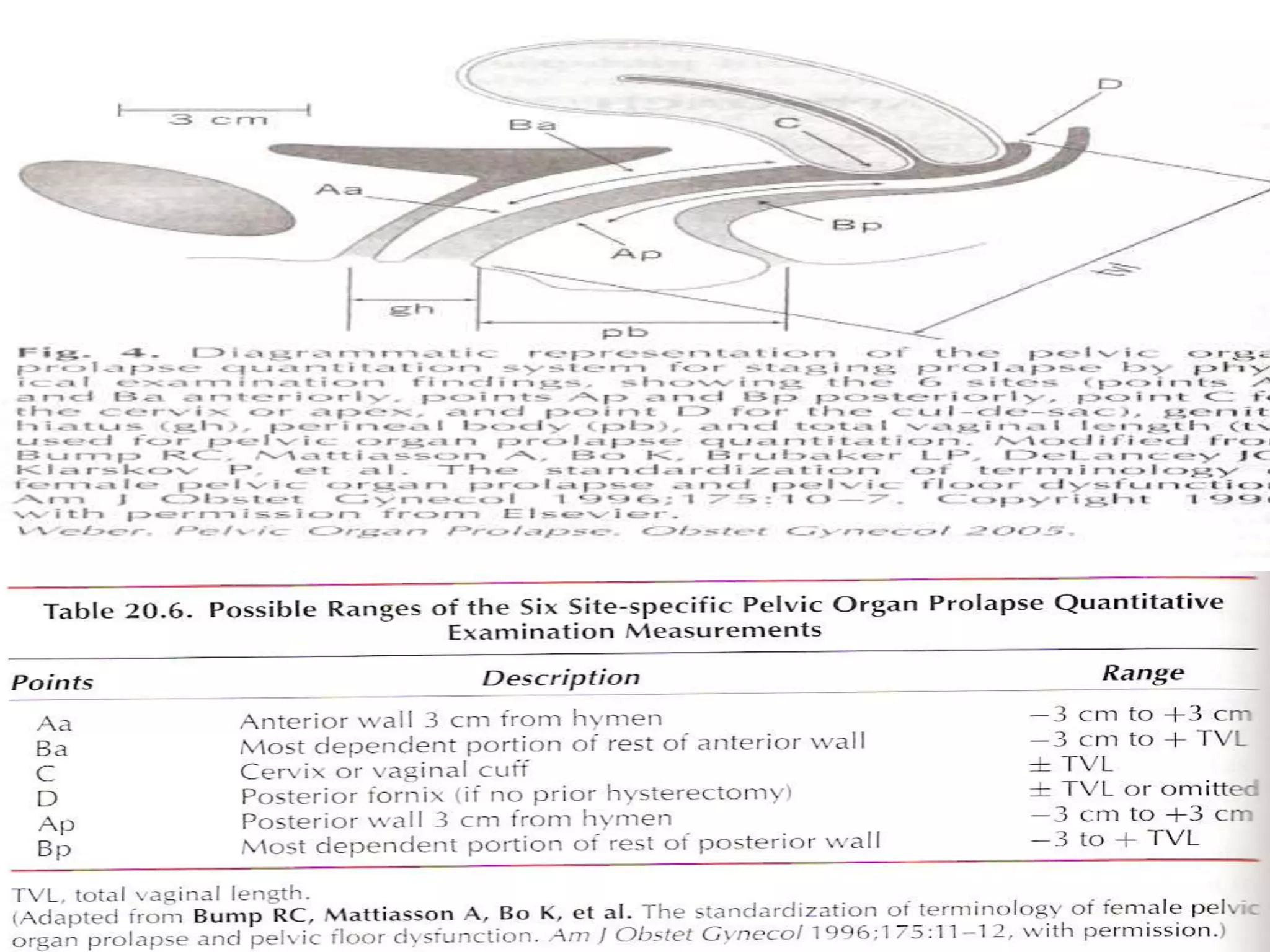 Pelvic organ prolapse | PPTX