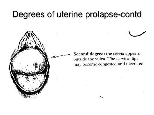 Pelvic organ prolapse