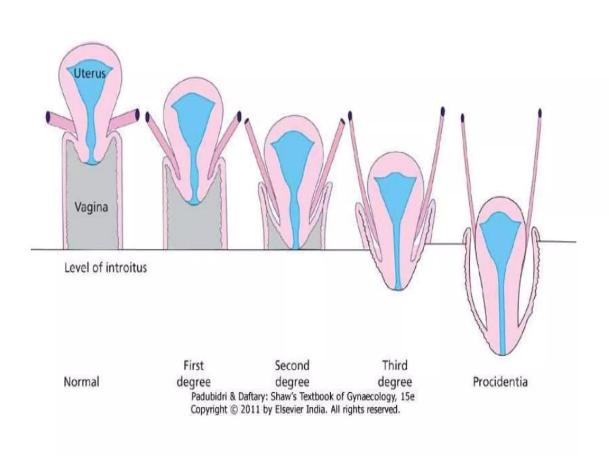 Pelvic organ prolapse | PPT