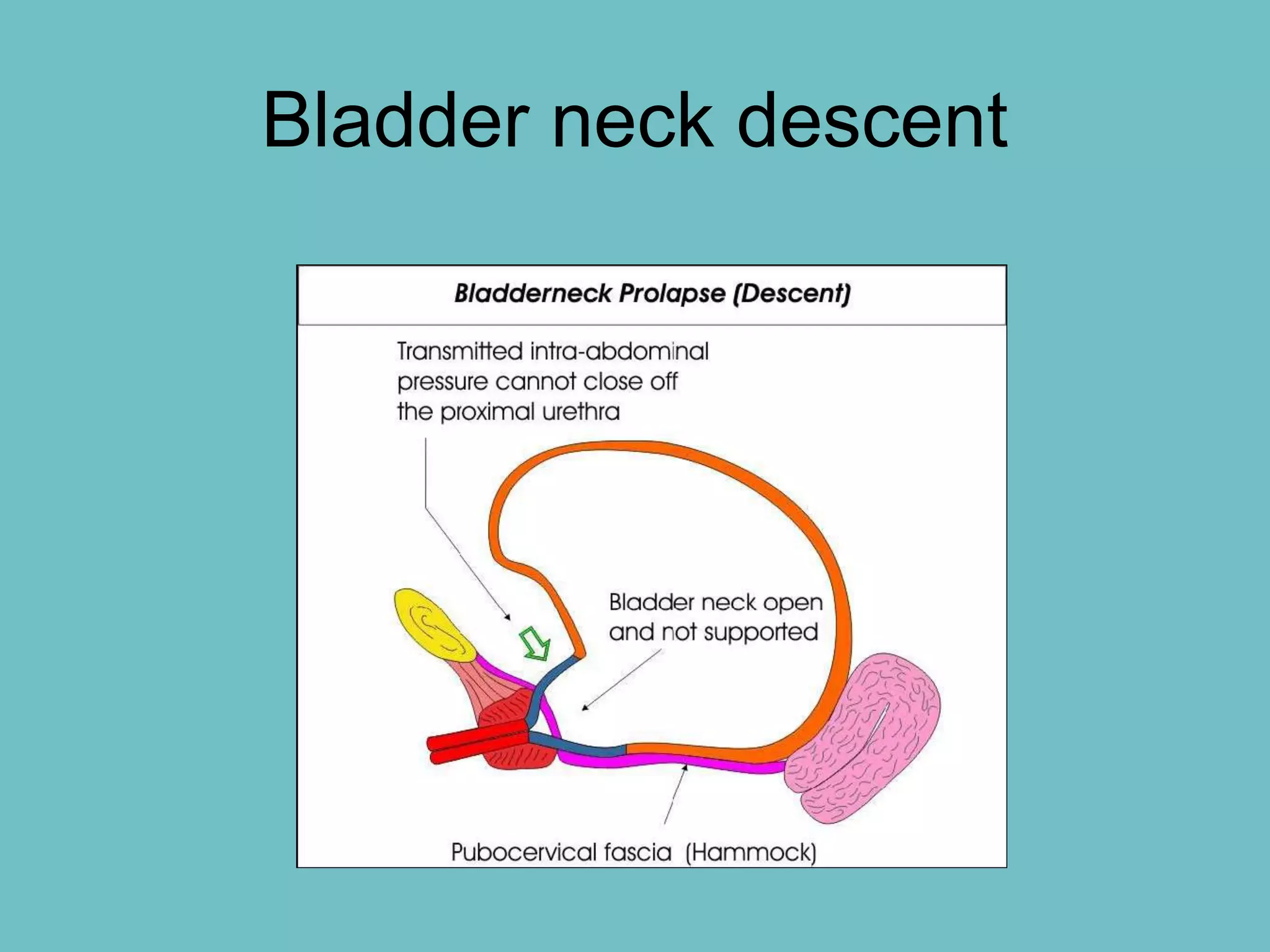 Pelvic organ prolapse | PPT