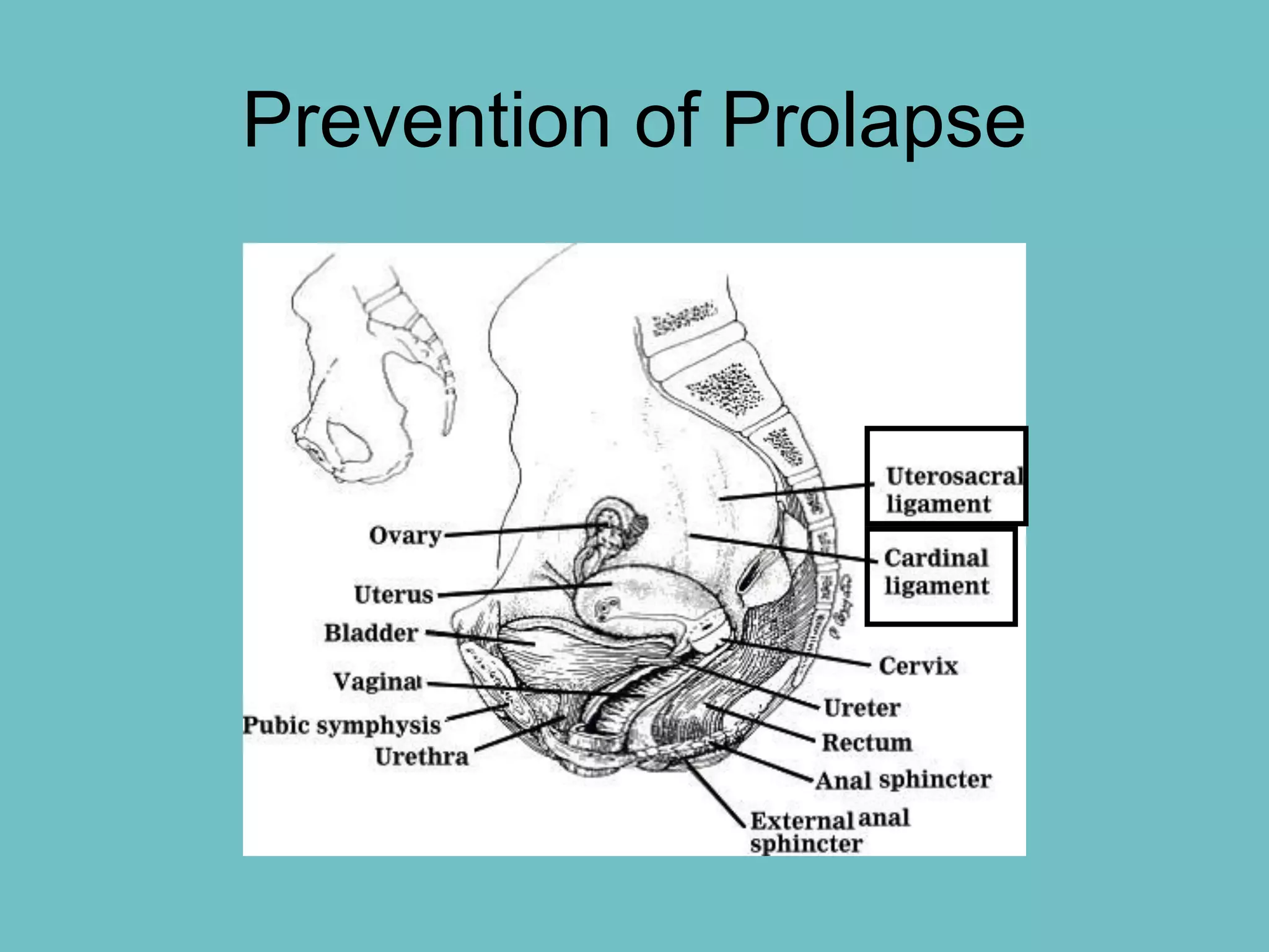 Pelvic organ prolapse | PPT