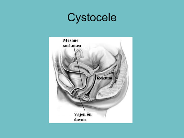 Pelvic organ prolapse | PPT