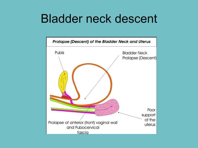 Pelvic organ prolapse | PPT