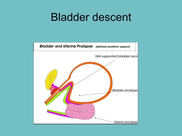 Pelvic organ prolapse | PPT
