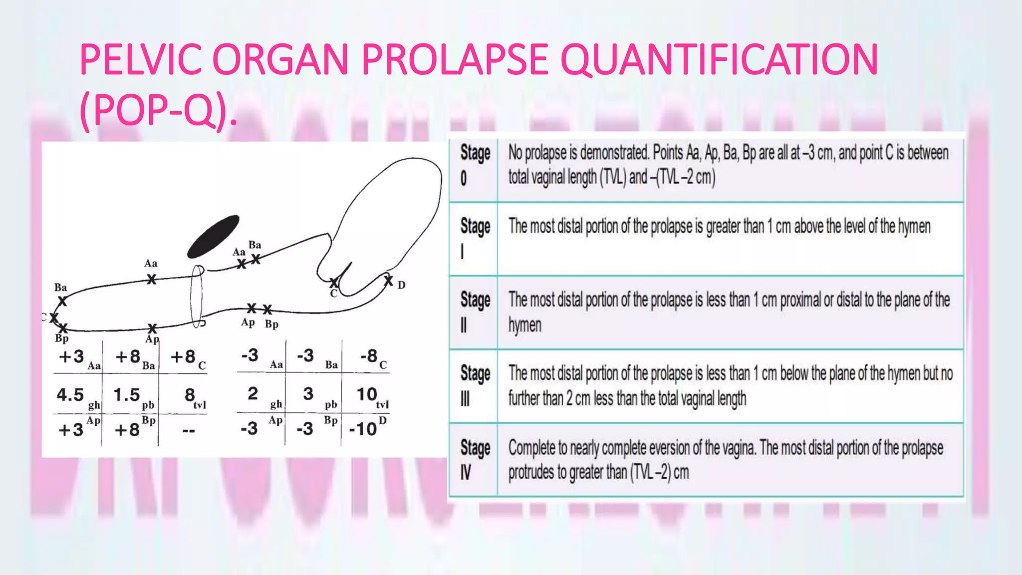 Pelvic organ prolapse (POP) | PPTX