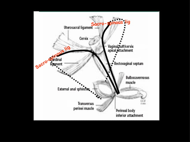 PelvicOrganReconstructive Surgery | PPT