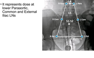 PELVIC LYMPH NODES TARGET DELINEATION Dr Syed Aman.pptx
